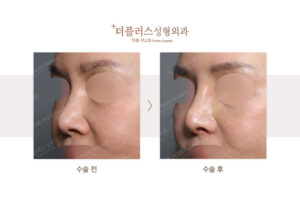 Before and After - THE PLUS PS