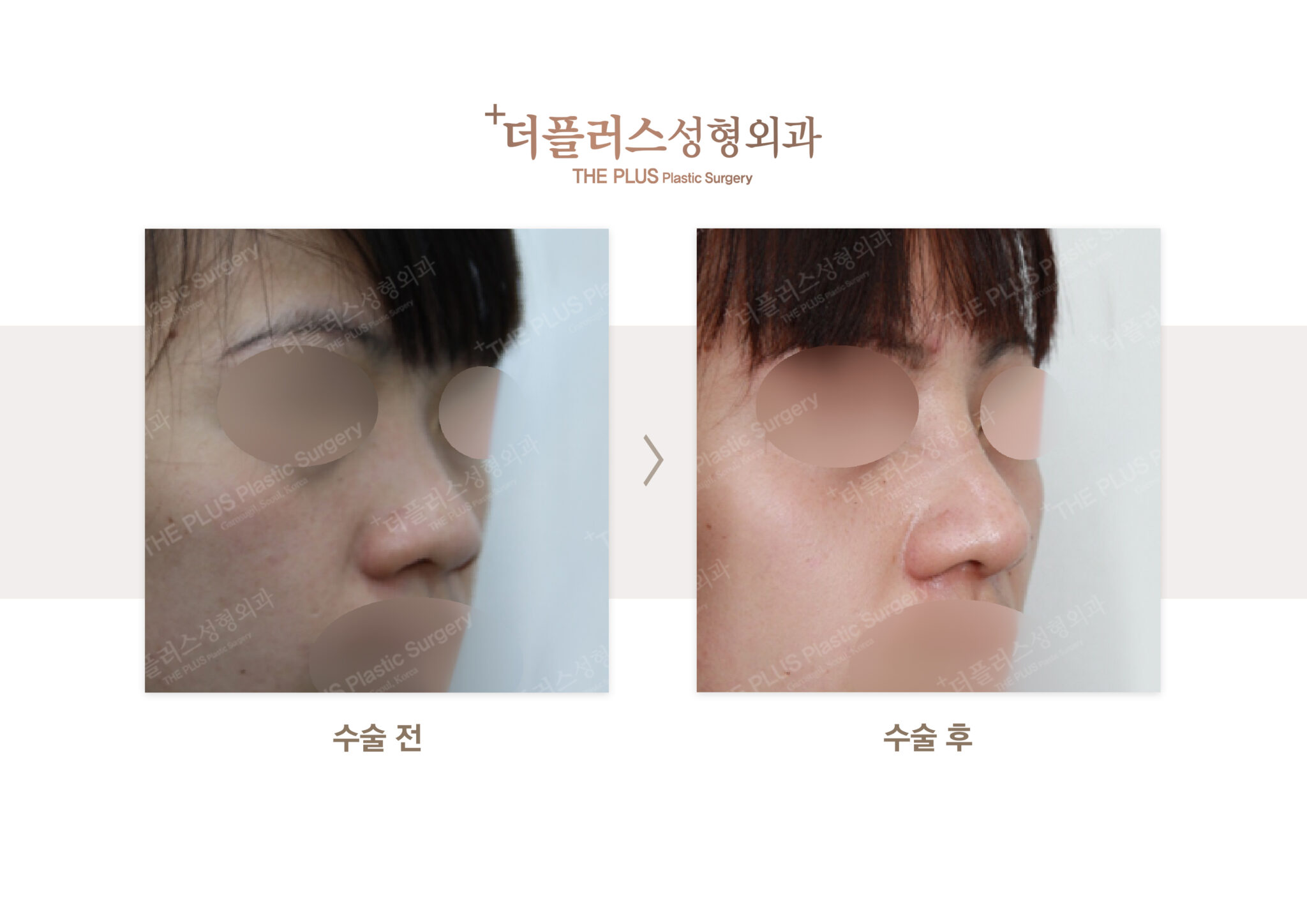 Before and After - THE PLUS PS