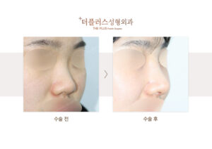 Before and After - THE PLUS PS