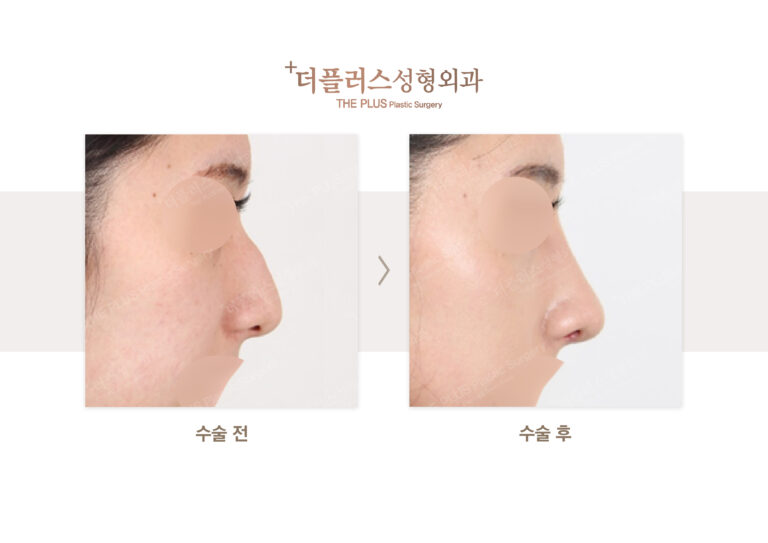 Before and After - THE PLUS PS