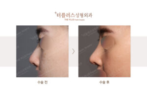 Before and After - THE PLUS PS