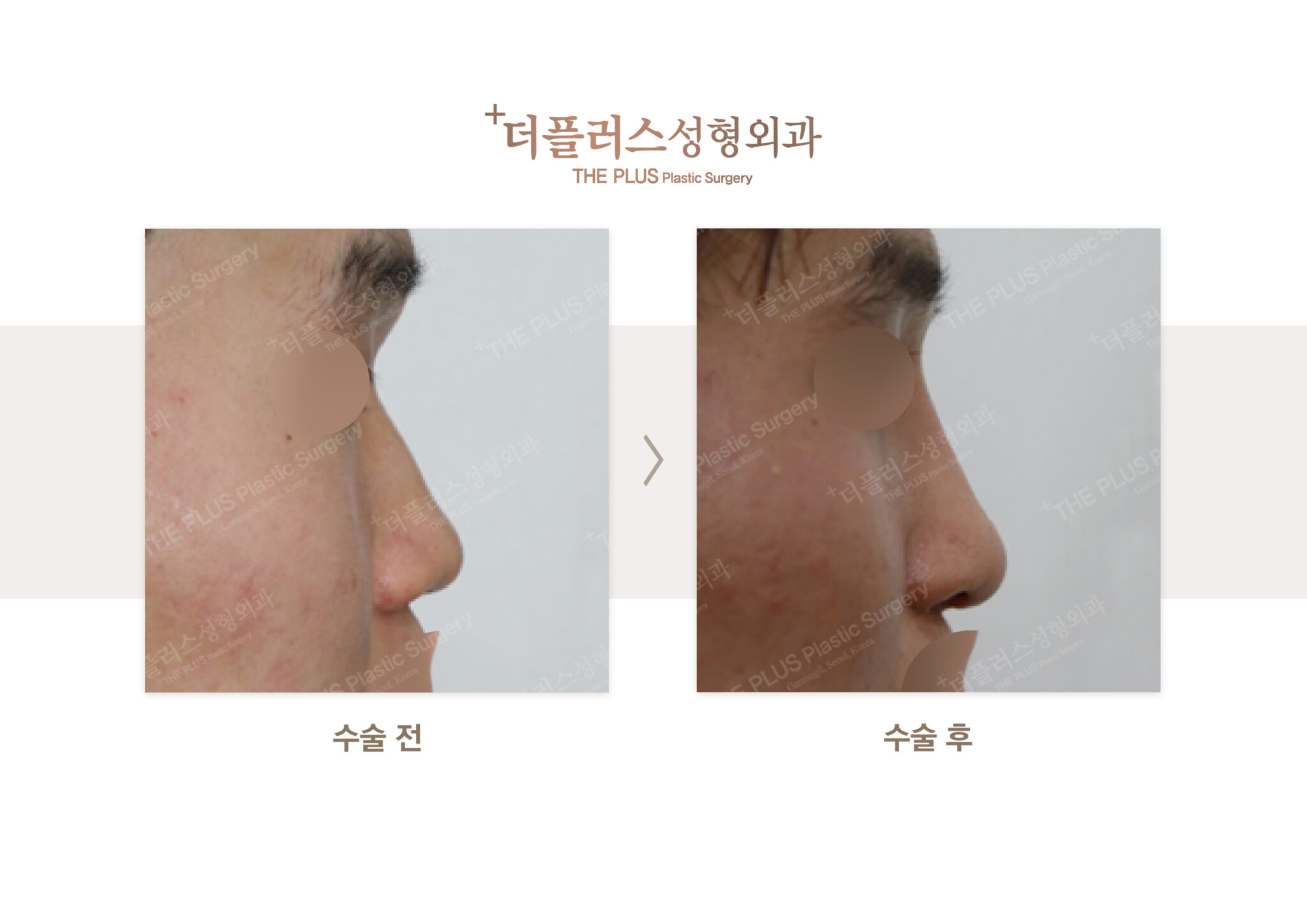 Before and After - THE PLUS PS