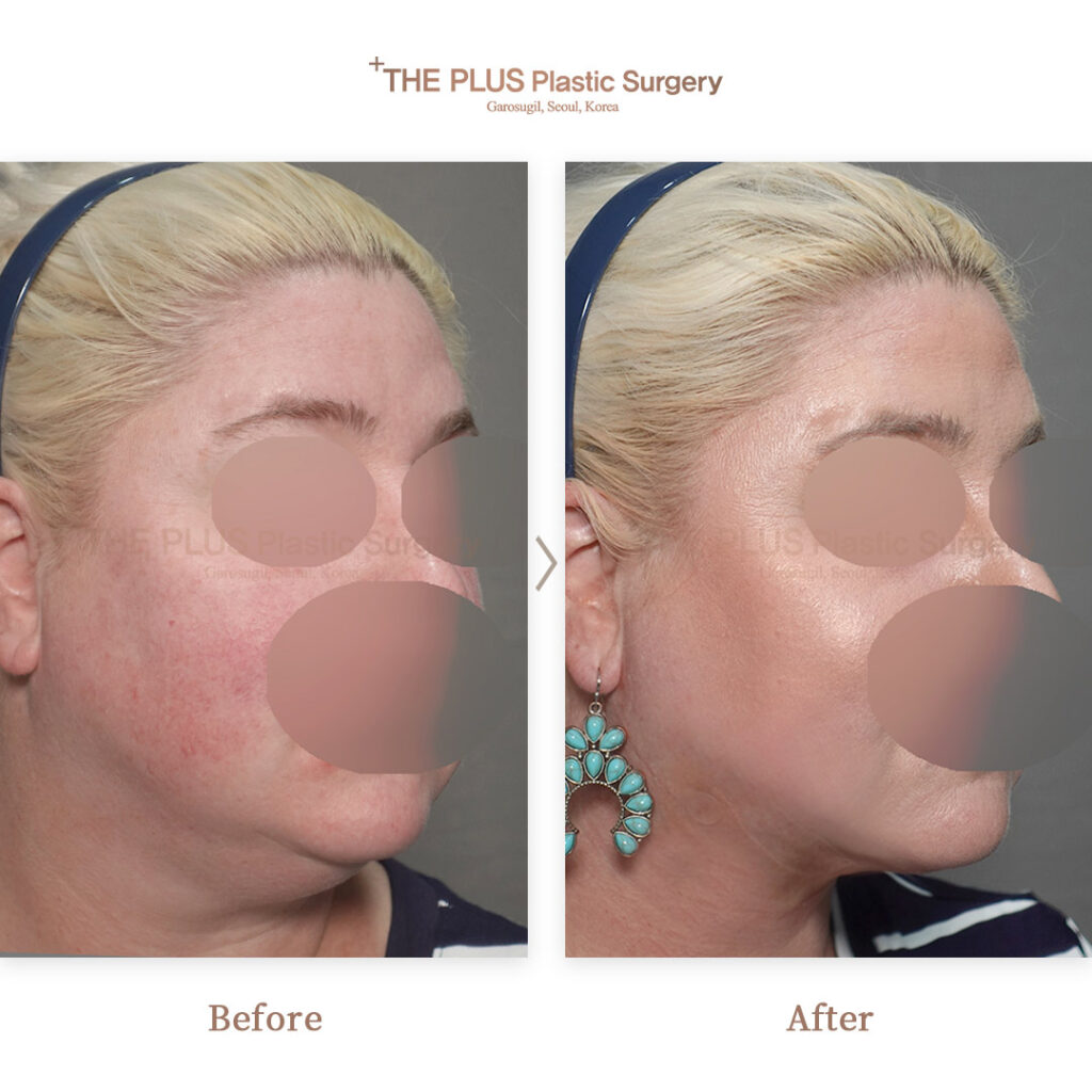 Before and After - THE PLUS PS